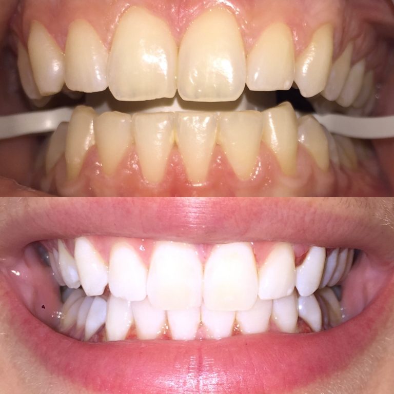 How To Get Whiter Teeth Dr Karen Kassabian
